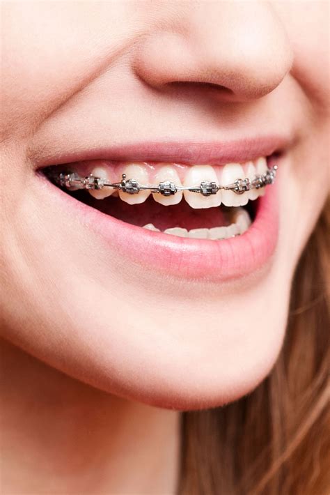 Braces San Antonio Tx Hulme Orthodontics Dental Braces