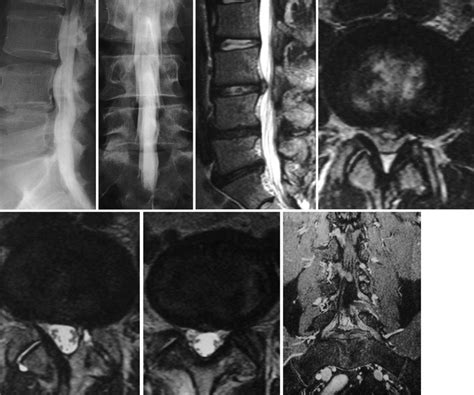 A G Case 2 A 35 Year Old Man With Bilateral Sciatic Pain He Had