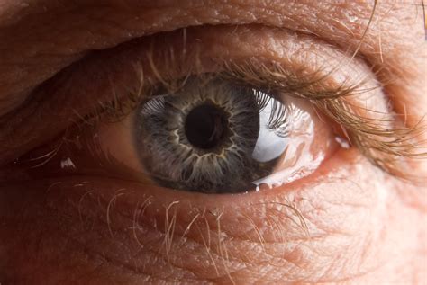 Conjunctivochalasis Eye Care In Sunnyside Ny
