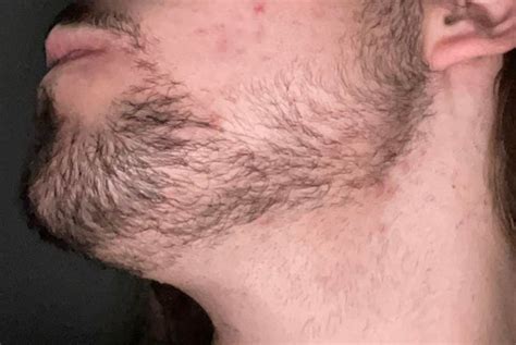 Liquid Or Foam Minoxidil Rminoxbeards