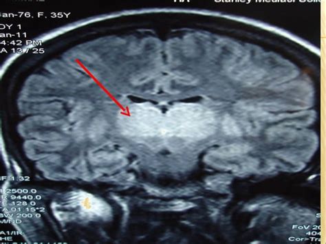 Mri Bilateral Thalamic Hyperintensities Ppt
