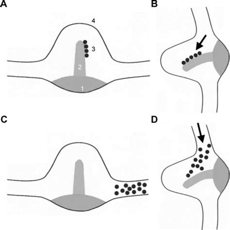 Full Article Benign Paroxysmal Positional Vertigo In The Elderly