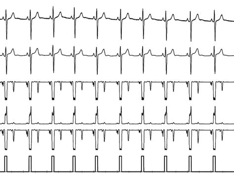 Qrs Detection For Record Mo1106 Of Cse Ecg Database A Raw Ecg B