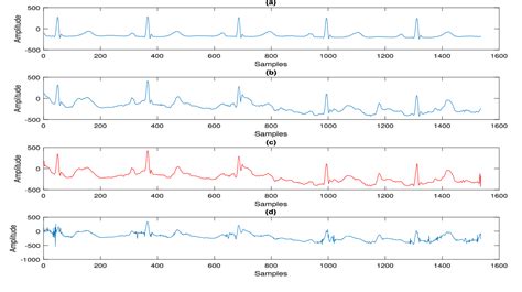 Figure 11 From Investigation Of Kronecker Based Recovery Of Compressed Ecg Signal Semantic Scholar