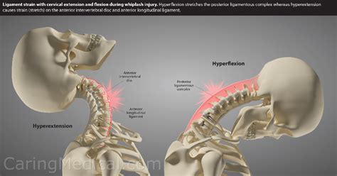 Hyperextension Neck
