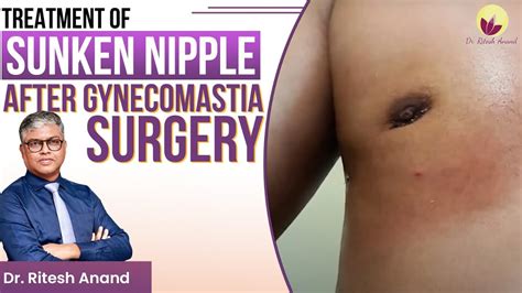 Gynecomastia Surgery Correction In Delhi Treatment Of Sunken Nipple