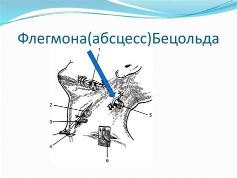 ПХО ран шеи.Типичные разрезы при абсцессах и флегмонах шеи ...