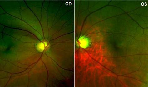 Glaucoma Without Cupping Page Of Retina Revealed