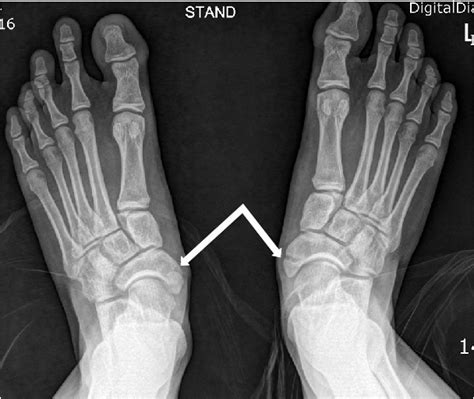 Figure 1 From Fractures Of The Tarsal Bone Semantic Scholar