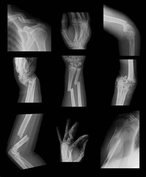 Impacted Fractures Bone Fracture Repair Femoral Neck Fractures