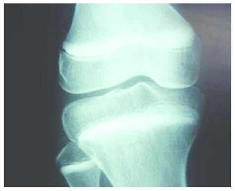 Sclerotic Metaphyseal Lines In The Distal Femur And Proximal Tibia And