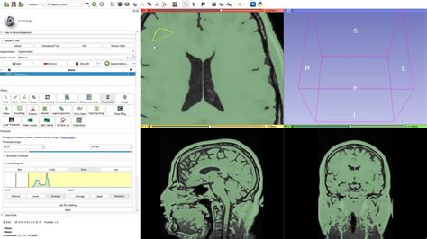 New Feature Histogram For Setting Threshold Range In Segment Editor Support 3d Slicer Community