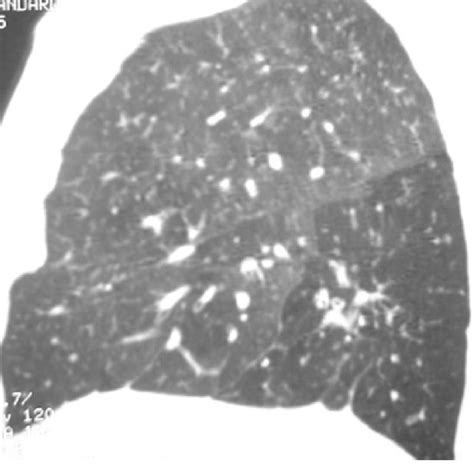 Rb Ild In A 42 Year Old Male Smoker With Progressive Dyspnea And