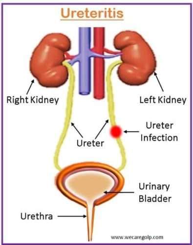 Ureteritis Causes Symptoms Management We Care