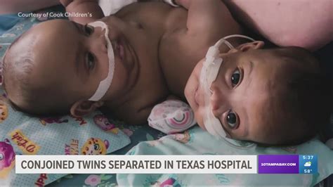 Conjoined Twins Successfully Separated At North Texas Hospital