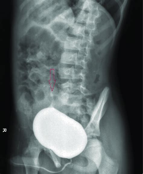 Voiding Cystourethrography Vcug Of The Patient Grade Ii