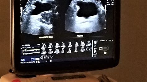 What Does An Ectatic Abdominal Aorta Mean On Ultrasound And When Is 2 9 Cm A Concern