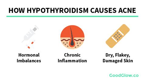 Is Your Thyroid Causing Cystic Acne Hypothyroidism And Acne Explained
