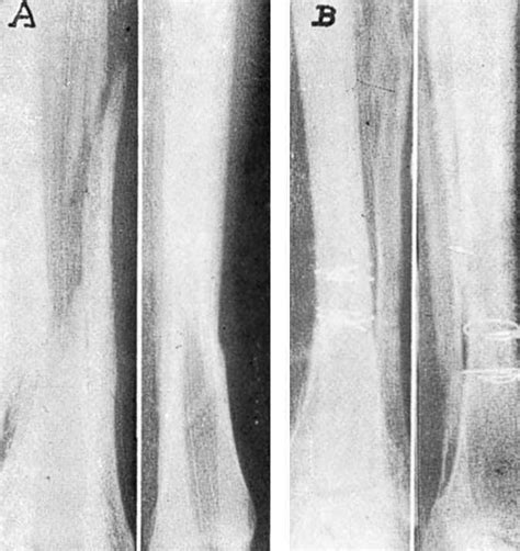 Fisiopatología Y Tratamiento De Las Fracturasdiafisarias De Tibia Revista Española De Cirugía