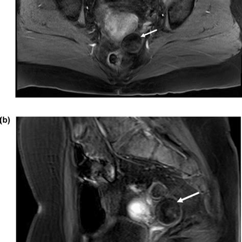 Axial A And Sagittal B 3d Volumetric Gradient Echo Sequence Post Download Scientific