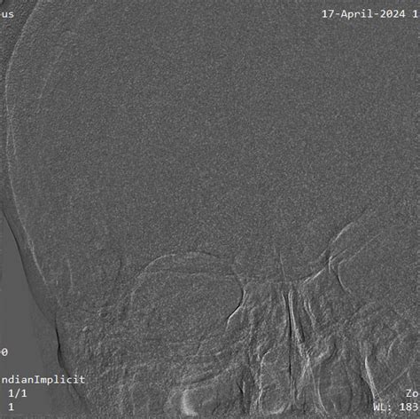 Dicom格式的dsa序列导入3d Slicer后切成数个dicom格式的图像，融合后像素改变。 问题求助 3dslicer中文论坛