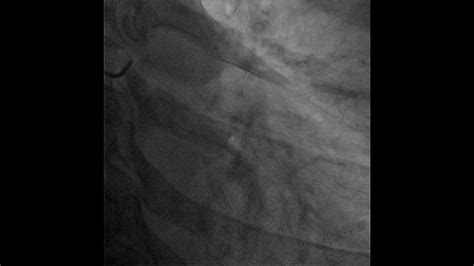 Mehdi Ouchiha On Linkedin 61 Yo Woman With Ecstatic Circumflex Stemi And Huge Thrombus Treated