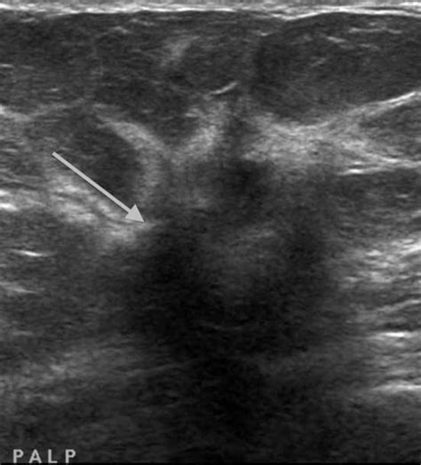 Brachial Plexus Neoplasm Semantic Scholar