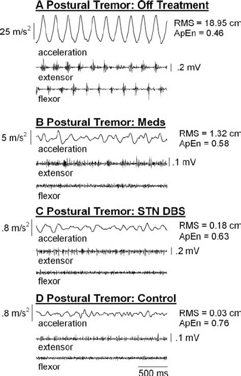 Acceleration Extensor Emg And Flexor Emg During Postural Tremor Of A Download High