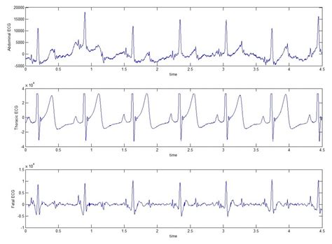 Matlab Code Of Fetal Ecg Extraction Using Wavelet Analysis