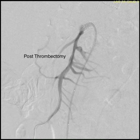 Acute Aortic Syndrome Unit Tbad With Sma Dissection And Thrombosis