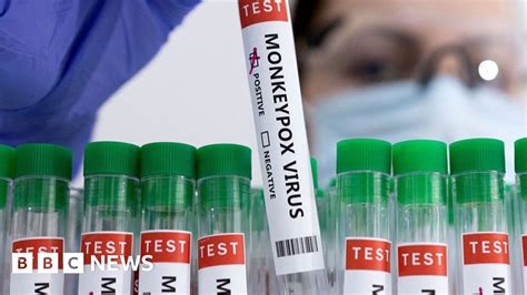 Monkeypox Fourth Case In Scotland Confirmed