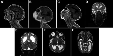 Microcephaly Mri