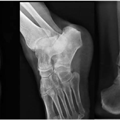 Last Follow Up Radiographic Control Showing Subtalar And Talonavicular