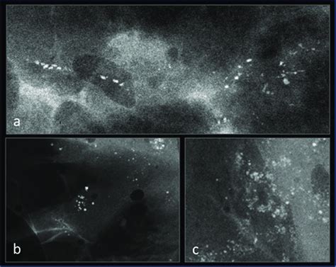 Radiological Images A Duct Centric Calcifications Casting