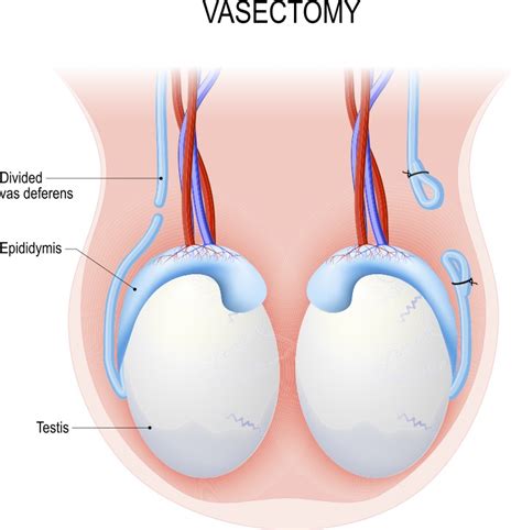 Vasectomy Safe Effective Affordable Birth Control For Men Mens