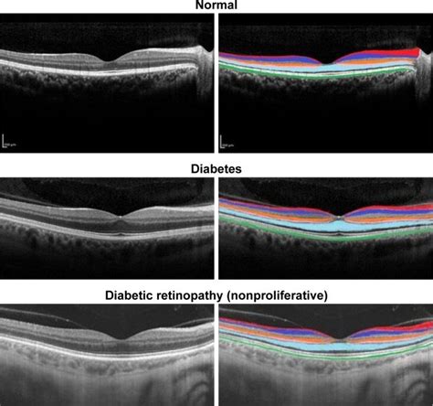 Retinal Layers Oct