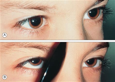 Other Vertical Strabismus Forms Clinical Tree