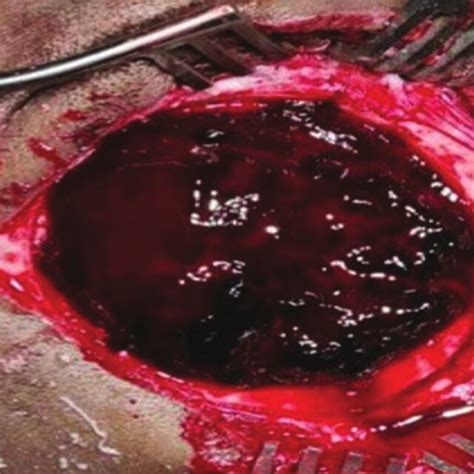 Left Parietal Craniotomy With Evacuation Of Extradural Hematoma