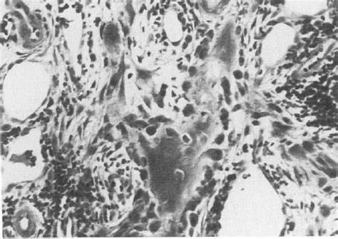 Microscopic Osteoid Osteoma Tissue Sample Magnification X 625 Stain Download Scientific