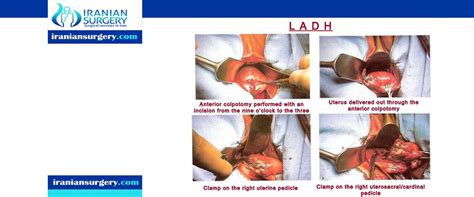 Anterior Colpotomy Procedure Iranian Surgery