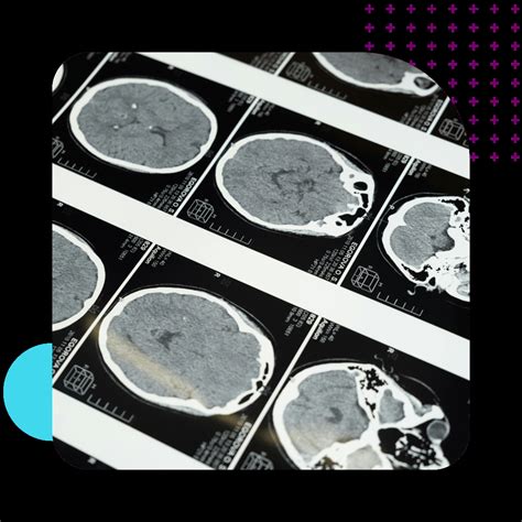 MND Vs MS Understanding The Key Differences Better Rehab