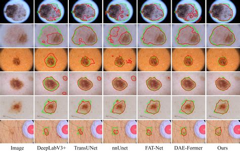 Cth Net A Cnn And Transformer Hybrid Network For Skin Lesion