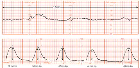 Fetal Monitoring Quiz Flashcards Quizlet