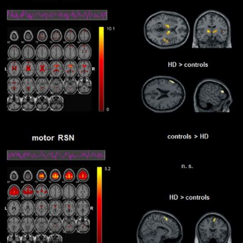 Brain Areas Showing Functional Connectivity Differences Between