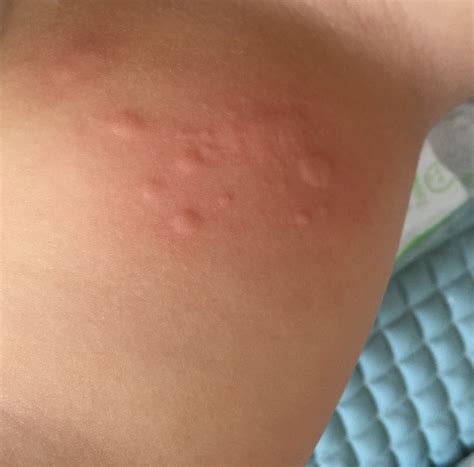 House Dust Mite Bites