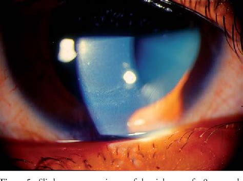 Figure 1 From Posterior Polymorphous Dystrophy And Keratoconus More