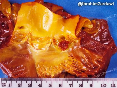 Infective Endocarditis