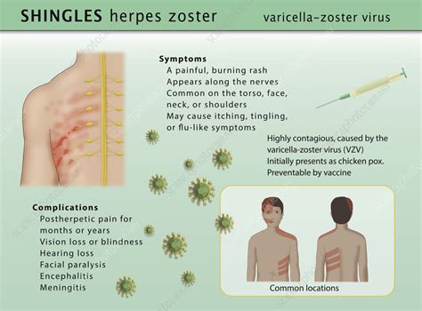 Shingles Rash Illustration Stock Image C0671044 Science Photo