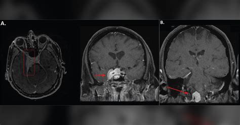 Woman Presents With Worsening Diplopia
