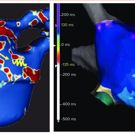 Recurrent Perimitral Flutter After Two Mitral Isthmus Ablations